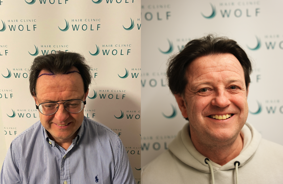 Alles over de DHI haartransplantatie | Hair Clinic Wolf