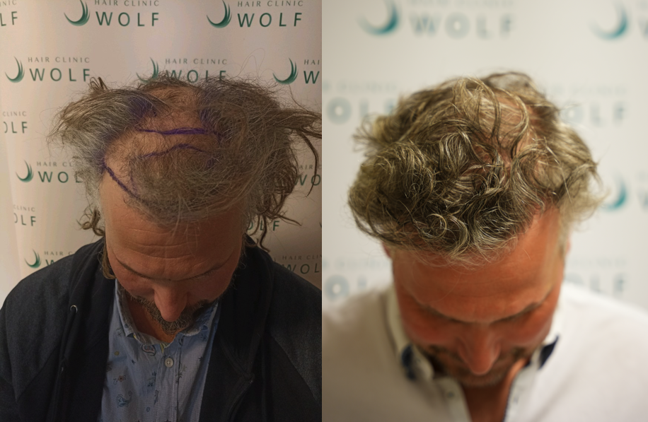 Alles over de DHI haartransplantatie | Hair Clinic Wolf